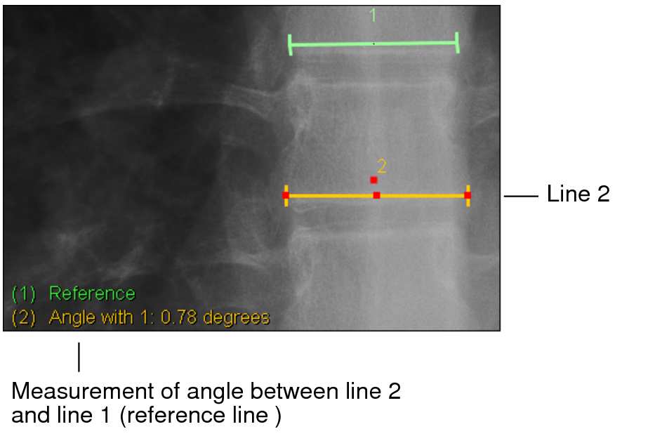 Measuring Cobb Angles