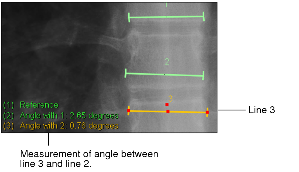 Measuring Cobb Angles