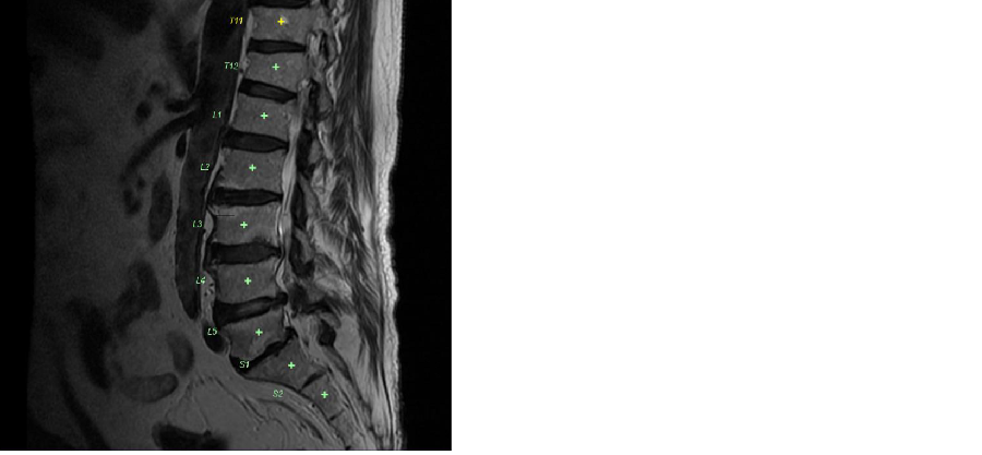 Spine Labeling